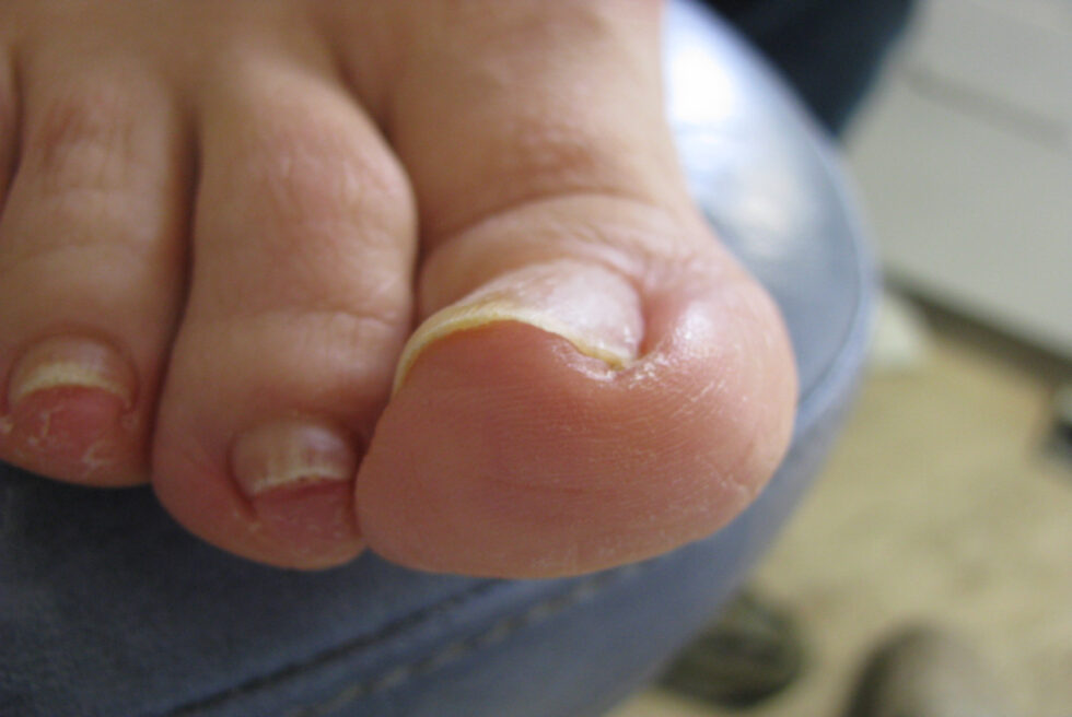 Ingrown Toenail: Causes, Symptoms & Treatment - Dr Foot Podiatry